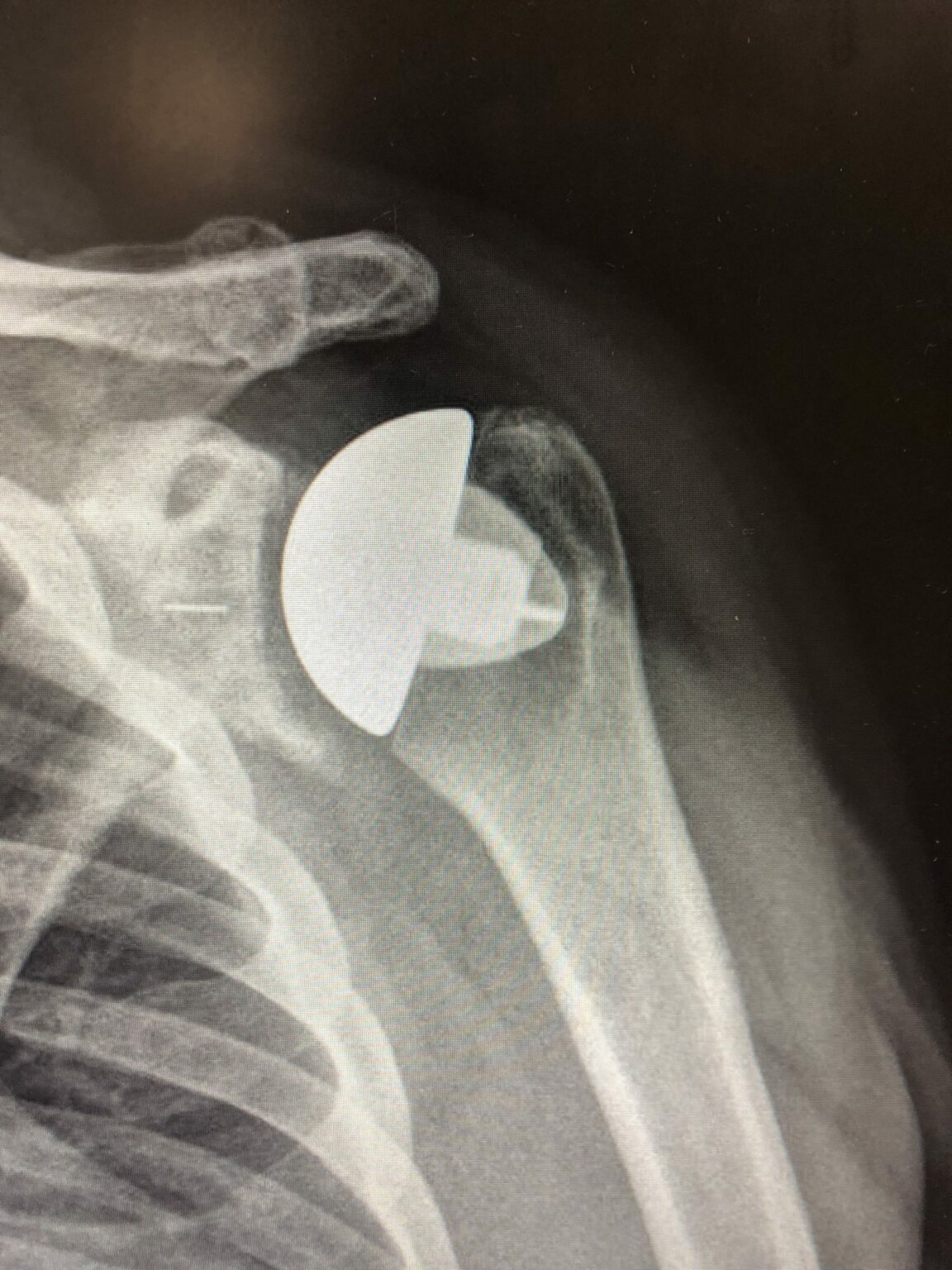 Shoulder replacement | Carolina Medical Center Poland